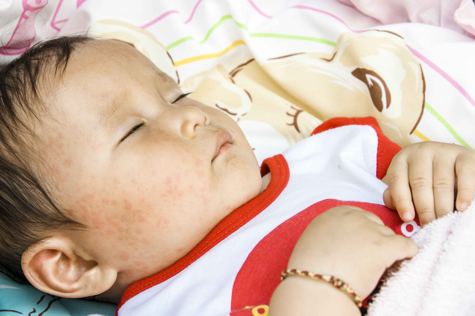 Roseola or three-day fever